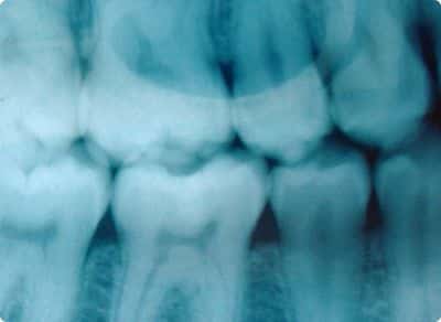 ᐅ Parodontose & Parodontitis: Ursachen, Symptome & Behandlung ...