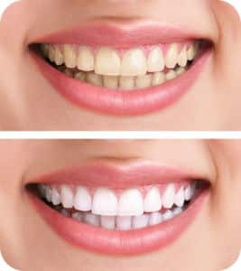 ᐅ Power-Bleaching: Wie funktioniert & was kostet es? - Bleaching Test